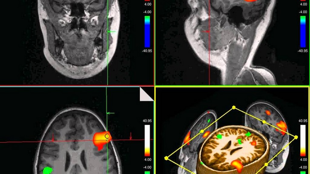 Sisteme RMN funcționale (fMRI).